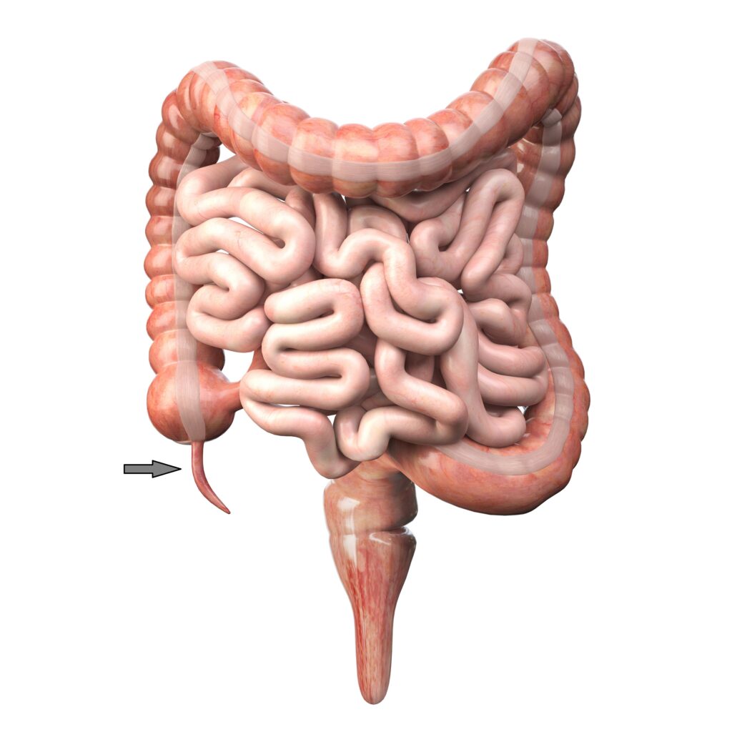 Cirugía del Apéndice - Ramon Martin Cirujanos